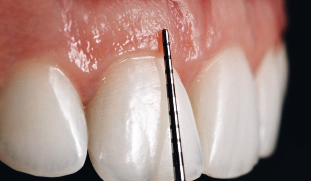 Tratament Parodontoză - Parodontologie Craiova, Băilești, Caracal, Slatina